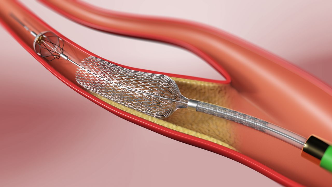 Carotid Artery Stent