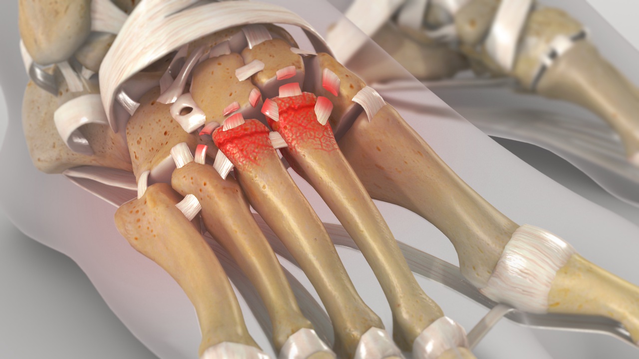 Midfoot Sprain Versus Lisfranc Injury Midfoot Dislocation Fracture