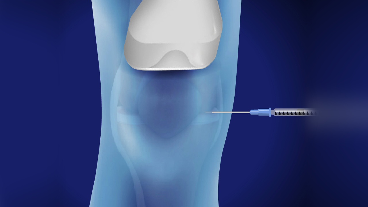 Ultrasound Guided Injection Ultrasound Guided Shoulder Joint And Bursa